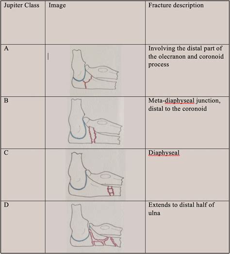 Proximal Ulna Fractures In Adults A Review Of Diagnosis And Management