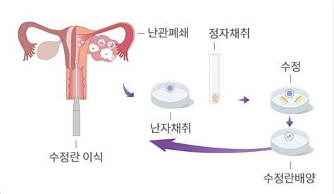 시험관 시술 핵심 총정리