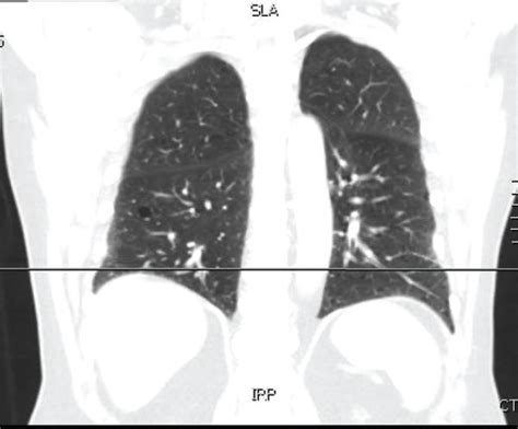 Case 1 A Ct Scan Chest Coronal View Demonstrating Subpleural