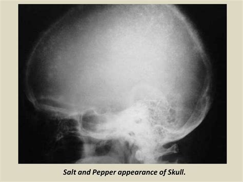 Hyperparathyroidism New