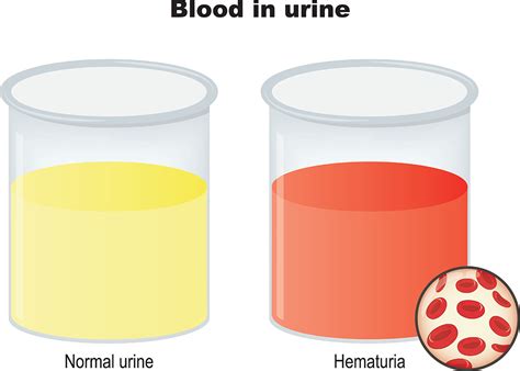 Foamy Urine No More Panic