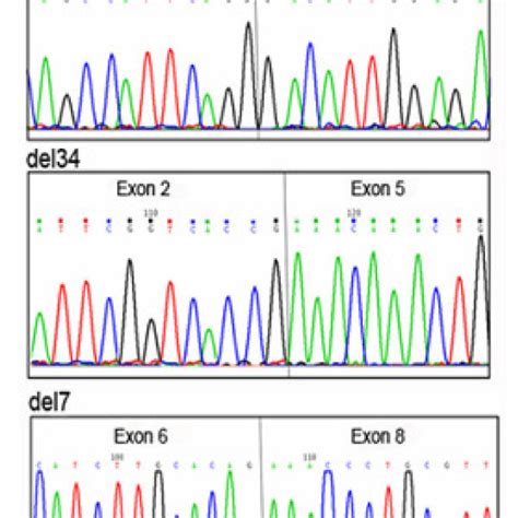 Sequencing Chromatograms Showing The Deletion Junctions Of The 5 Novel Download Scientific