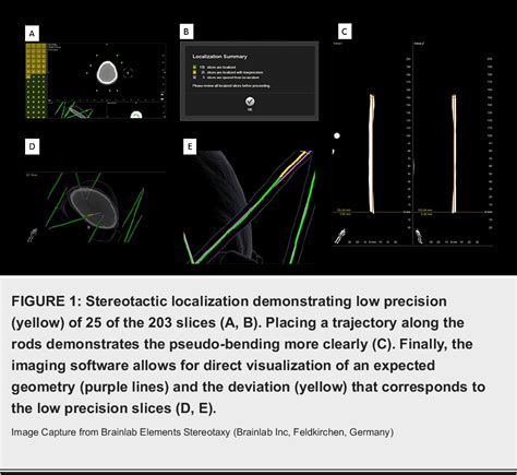 Figure 1 From Motion Detection And Correction For Frame Based Stereotactic Localization