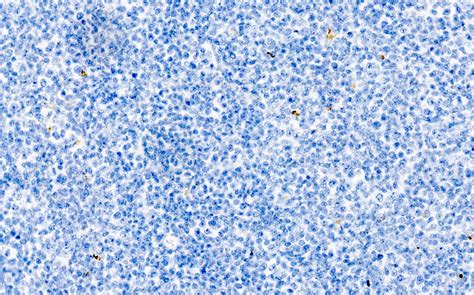 Pathology Outlines Progressive Transformation Of Germinal Centers