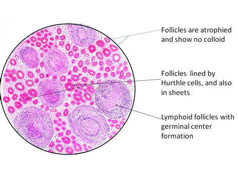 Hashimotos Thyroiditis Pathology Made Simple