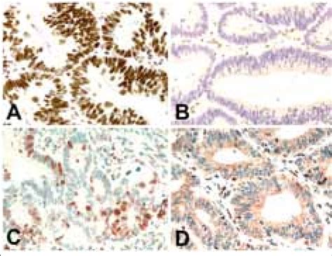 Representative Mmr Immunohistochemical Expression Patterns A Positive Download Scientific
