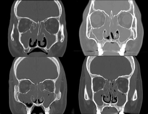 Computed Tomography Findings In Patients With Samters Triad An