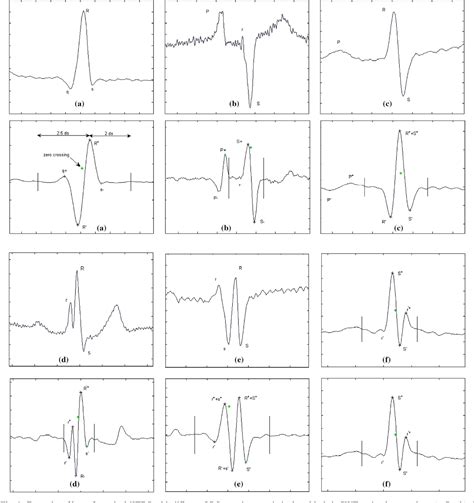 Figure 1 From A New Mathematical Based Qrs Detector Using Continuous