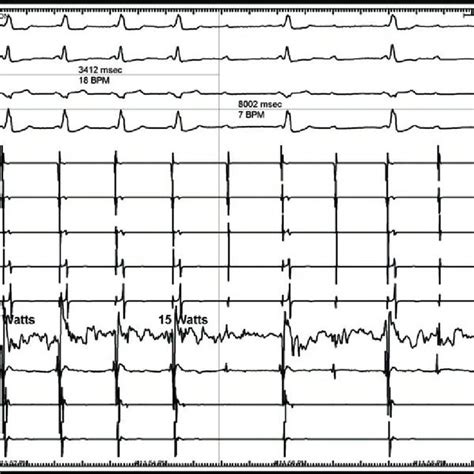 Manifest Pre Excitation Consistent With A Mid Septal Accessory Pathway Download Scientific