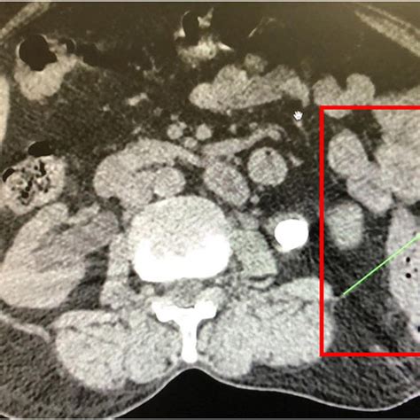 Final Retromuscular Preperitoneal Mesh Position Download Scientific Diagram
