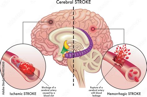 Medical Illustration Compares The Causes Of Two Types Of Cerebral