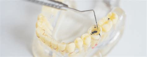 Caries Radicular ¿qué Es Y Cómo Tratarla Clínica Oroa