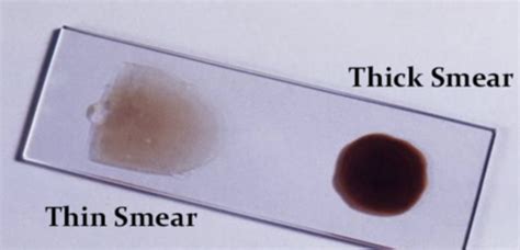 Malaria Diagnosis Flashcards Quizlet