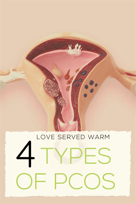 The Naked Truth With Pcos Exposed The Voiceless Fertility Robber Love