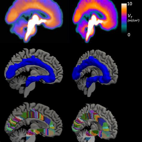 Visualizing The 5 Htt Serotonin Axonal Tract Average Volume Of