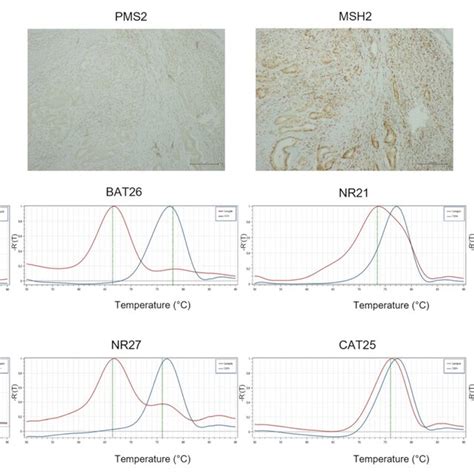 Representative Results Of Gc Case Showing Dmmr Ihc And Mss By Pcr A
