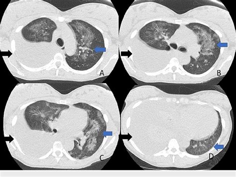Figure 1 From Postpartum Chylothorax A Case Report And Review Of The Literature Semantic Scholar