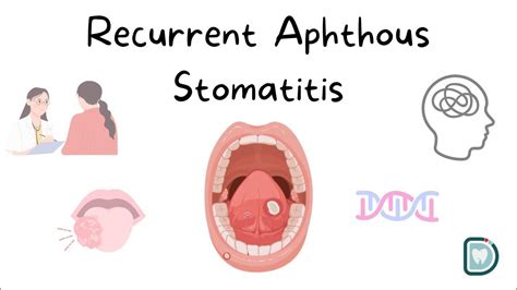 Understanding Recurrent Aphthous Stomatitis Oral Aphthous Ulcers Youtube
