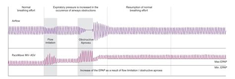 ASV Algorithm ResMed Schweiz