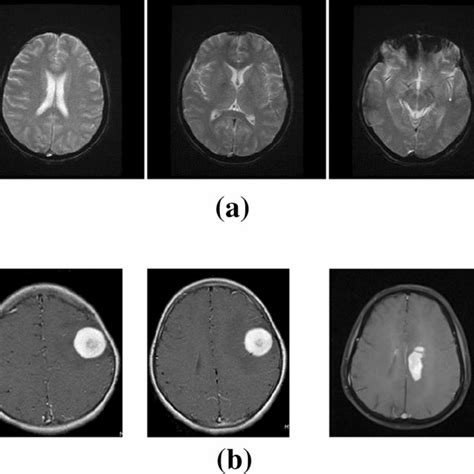 MRI Brain Tumor Detection Using Optimal Possibilistic Fuzzy C Means Clustering Algorithm And