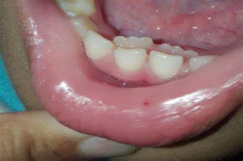 Gigi Tetap Sudah Muncul Tapi Kok Gigi Susu Belum Goyang