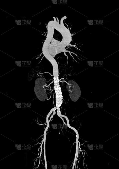 全身ct血管造影。三维渲染图像