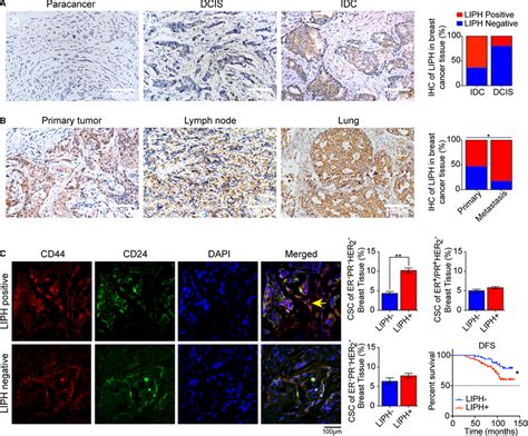 Liph Expression Is Associated With Metastasis And Poor Prognosis In