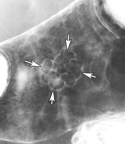 Upper Gi Series Ulcer