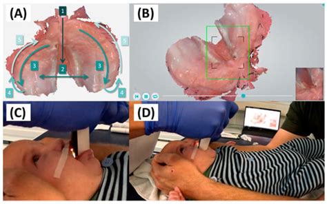 Complete Digital Workflow For Manufacturing Presurgical Orthodontic Palatal Plates In Newborns