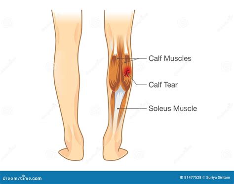 Calf Muscle Tear Stock Vector Illustration Of Hard 81477528
