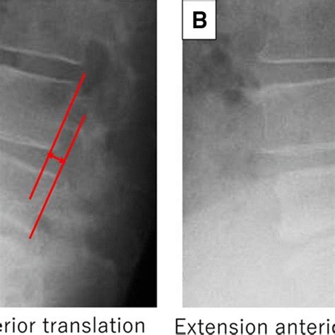 The Correlation Between Anterior Translation Ratio And T2 Relaxation