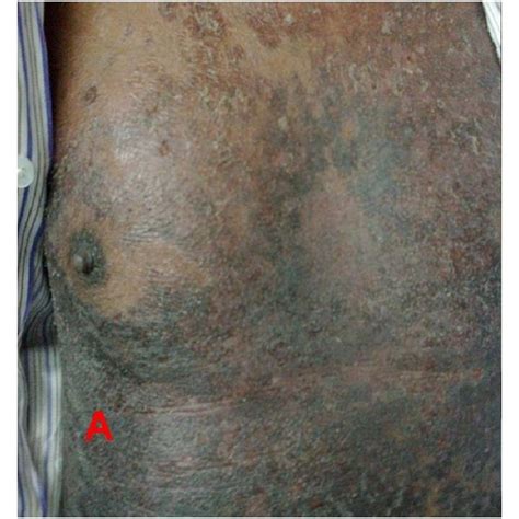 A Extensive Exfoliation And Hyperpigmentation On Trunk After Starting