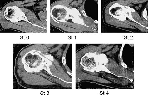 Natural History Of Infraspinatus Fatty Infiltration In Rotator Cuff