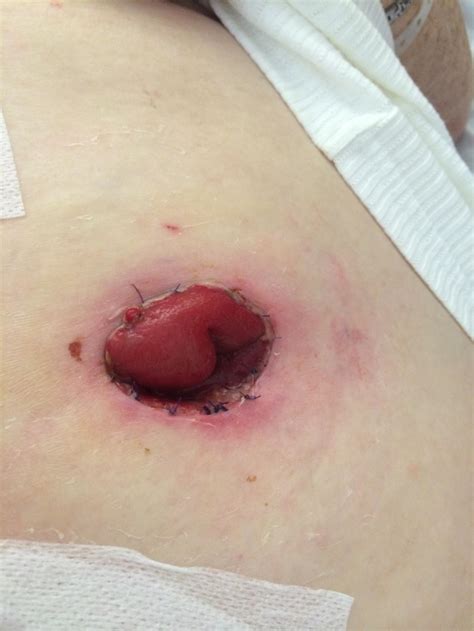 A Case Of Surgically Treated Peristomal Pyoderma Gangrenosum In A