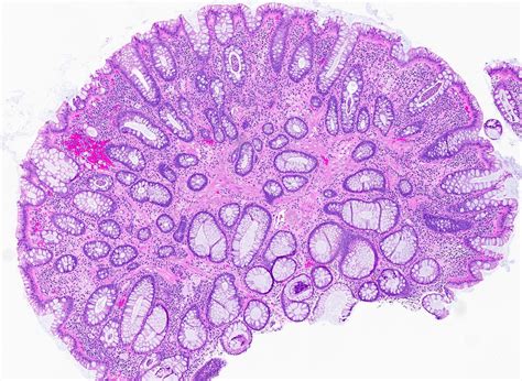 Hyperplastic Polyp Pathology Outlines Clinical Pathology Intestinal