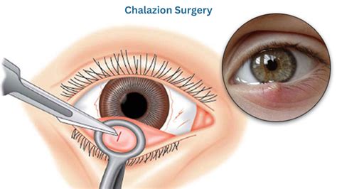 Chalazion Surgery Symptoms Causes Treatment And After Care
