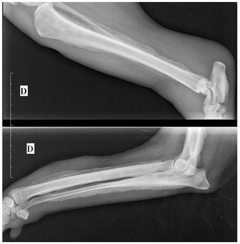 Hypertrophic Osteopathy Associated With A Prostatic Adenocarcinoma In A