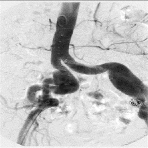 Postanastomosis Aorto‑bi‑femoral Bypass Grafting Figure 3 Download Scientific Diagram