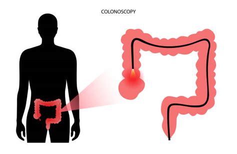 80 Colorectal Cancer Research Stock Illustrations Royalty Free Vector