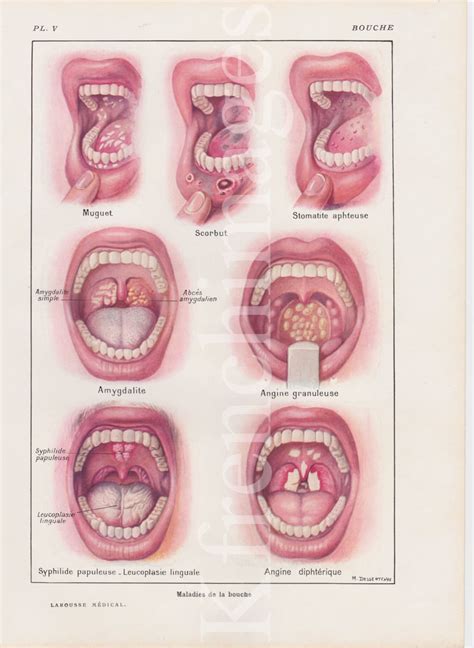 Mouth Diseases Anatomy Print 1920s French Medical Illustration Etsy