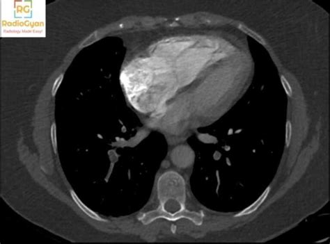 Pulmonary Embolism Diagnosis What Else The Radiologist MUST Report RadioGyan
