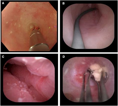 Endoscopic Retrograde Appendicitis Therapy Current And The Future Pmc