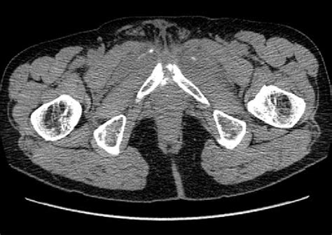A Computed Tomography Cystogram Demonstrating Bilateral Fluid Download Scientific Diagram