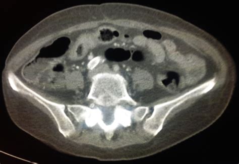 Abdominal And Pelvic Ct