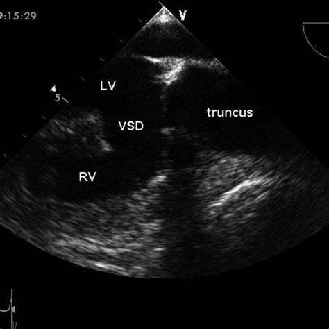 The Transoesophageal Echocardiogram With The Probe In Transgastric Download Scientific Diagram