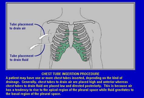Chest Tube Placement Intercostal Space