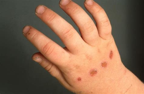 What S The Cigarette Burn At Darcy Simoi Blog