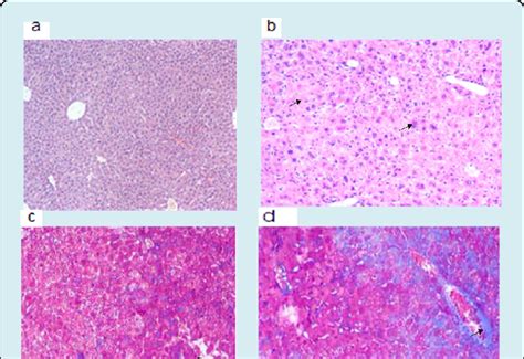 The Depicted Figure Showed A Normal Liver Parenchyma B The Highest Download Scientific