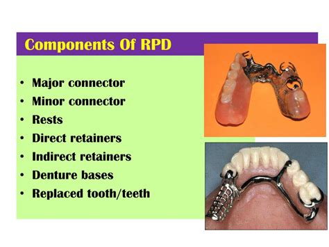 Parts Of Removable Partial Denture Design Talk