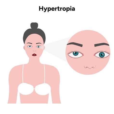 Premium Vector Eye Problem Disease Strabismus Hypertropia